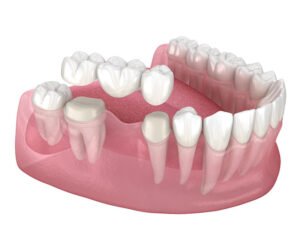 Root Canal Treatment: Everything You Need to Know in Malaysia