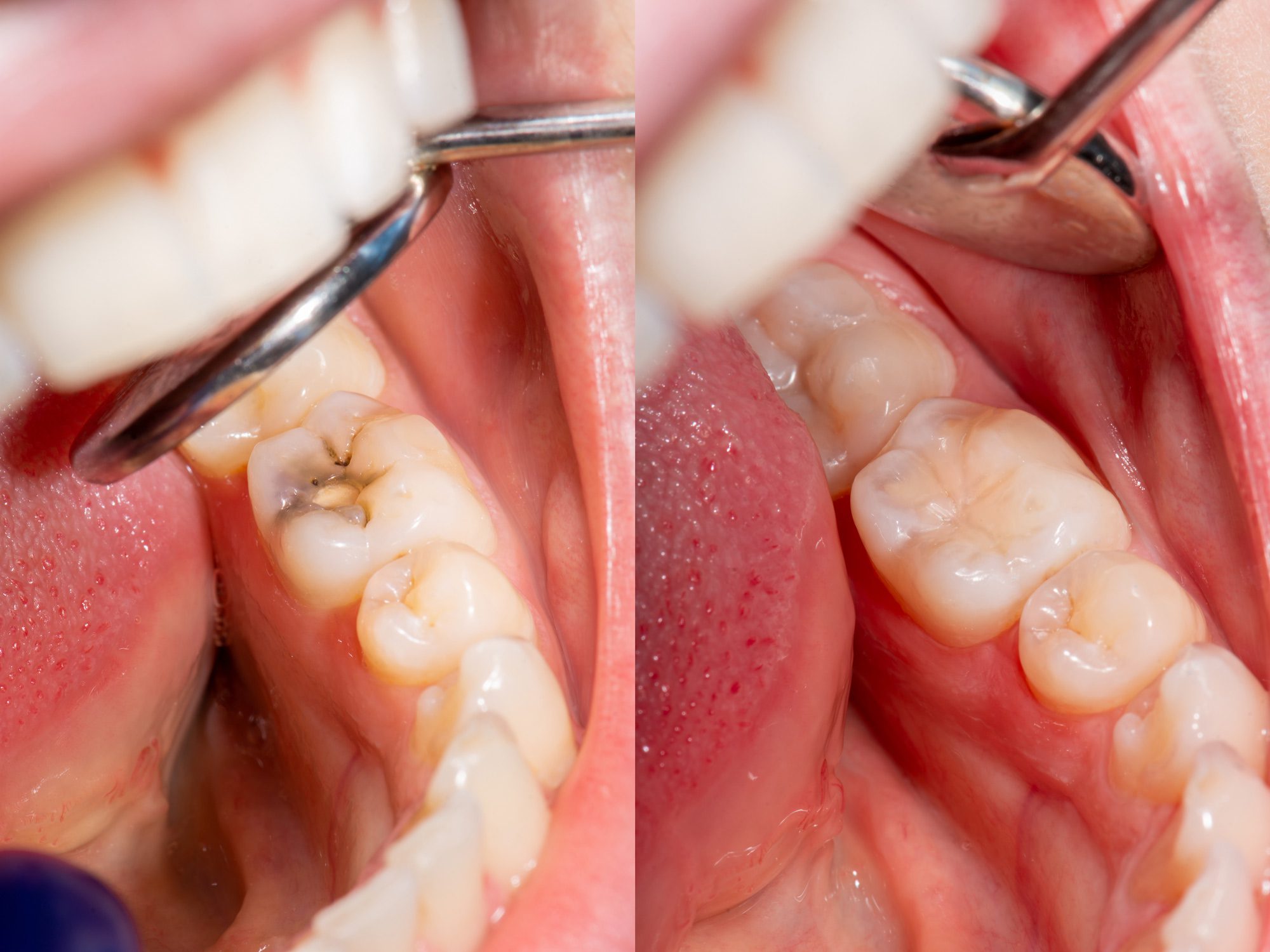 Teeth Filling: Everything You Need To Know in Malaysia