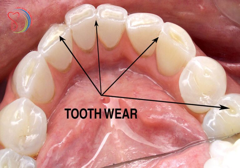 Tooth Wear: Everything You Need to Know in Malaysia